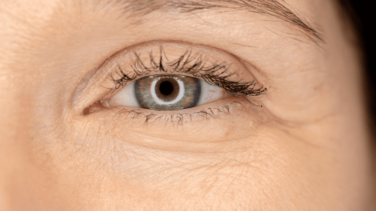 Vakava sarveiskalvon tulehdus uhkaa etenkin piilolinssien käyttäjiä ...