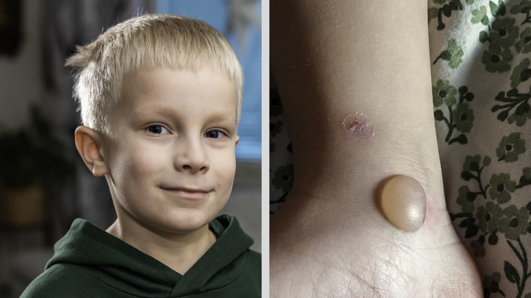 Ilmari Honkasella on niin harvinainen sairaus, että äiti tietää siitä ...