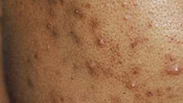 Vad är akne och vem får det? | X3M | Svenska Yle