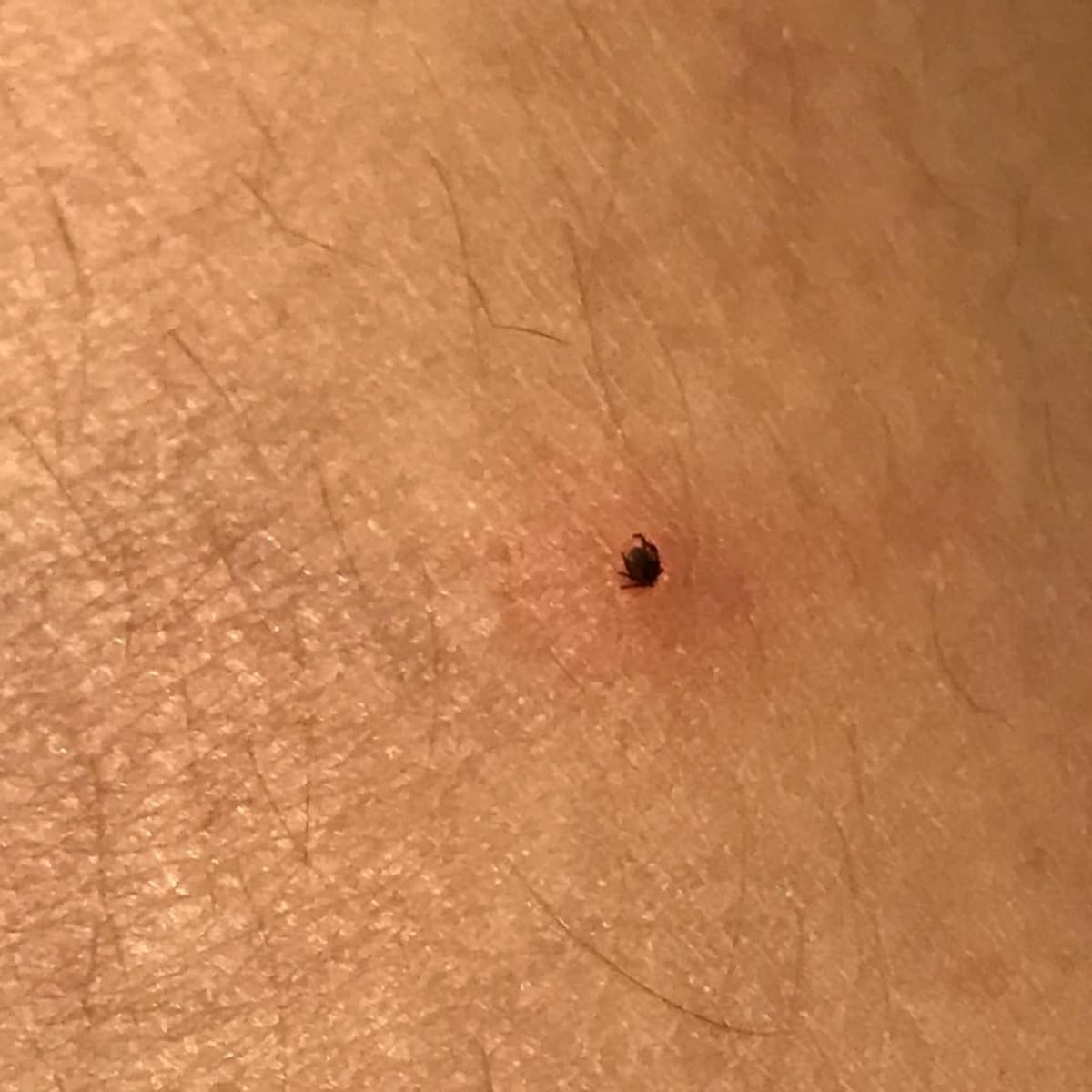 Punkki voi purra myös tammikuussa – turkulaisäiti: "Monet hämmästyivät ...