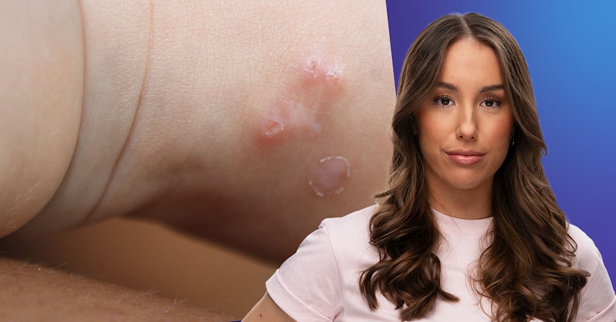 Skabb blir allt vanligare – vi förklarar hur parasiten hittar dig och hur du blir av med den ...