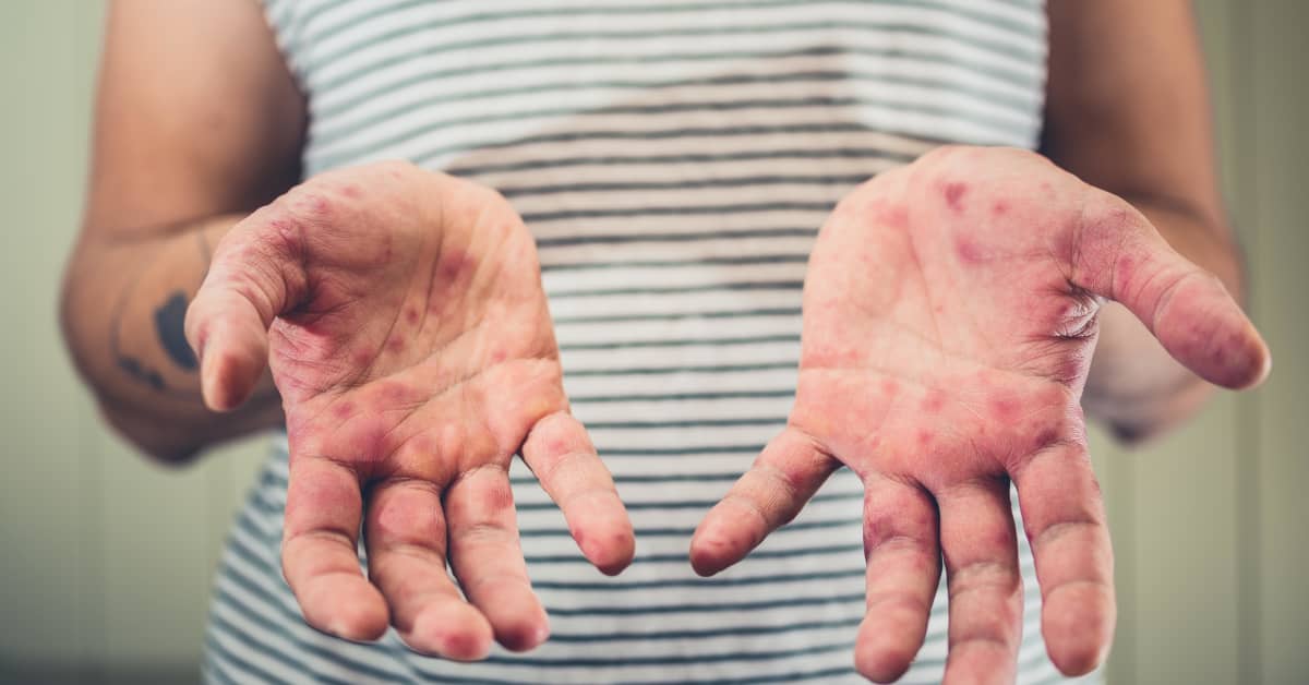 Enterovirusta liikkeellä Suomessa tavanomaista enemmän – Turussa ...