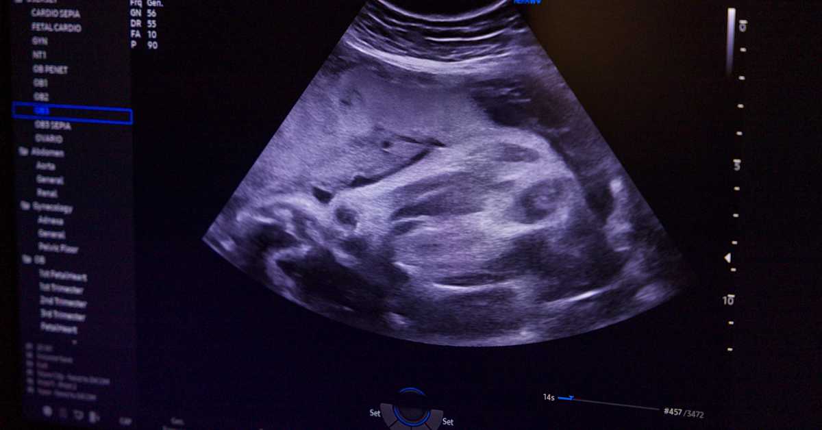 Tutkimus: Lääkkeellinen abortti on turvallinen jo suositeltua aiemmin ...