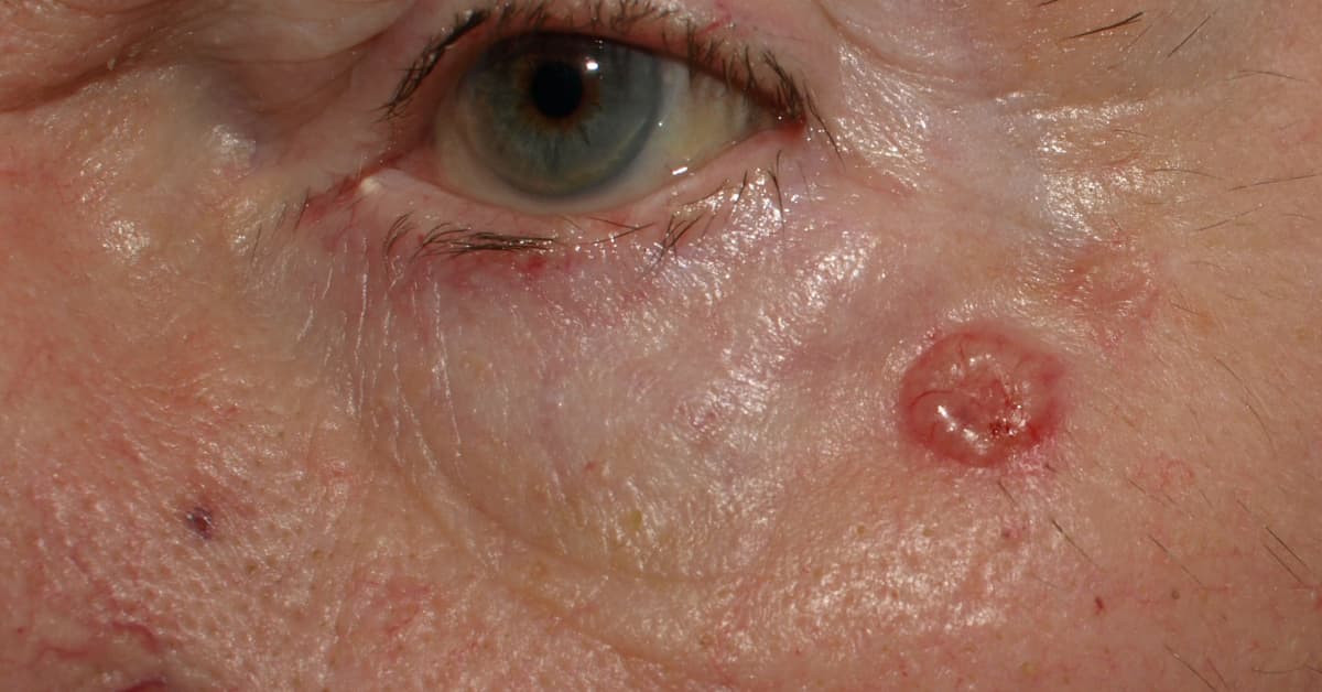 Basaliom (basalcellscancer) – när och hur operera? | Hälsa | Svenska Yle