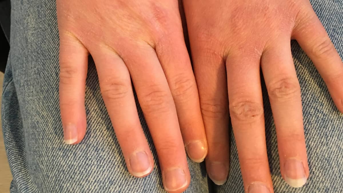 Lasten käsi-ihottumat ovat lisääntyneet koronan aikaan – jatkuva käsien ...