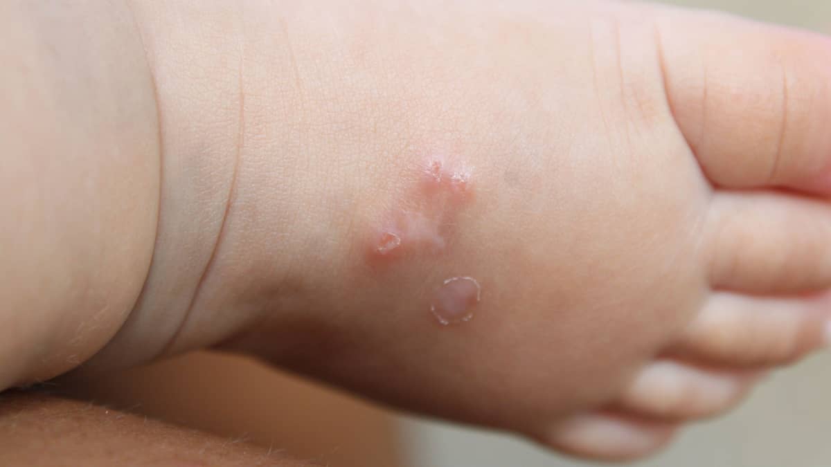 Syyhy on levinnyt tänä vuonna ennätyksellistä tahtia, mutta tarkkaa syytä ei tiedä kukaan ...