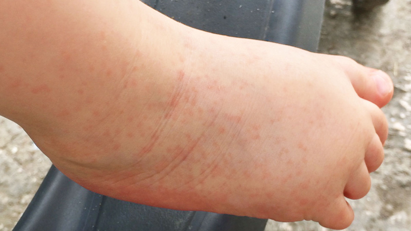 Vantaalaisisä sairasti enterorokon rajuna – kynnet lähtivät ja ...