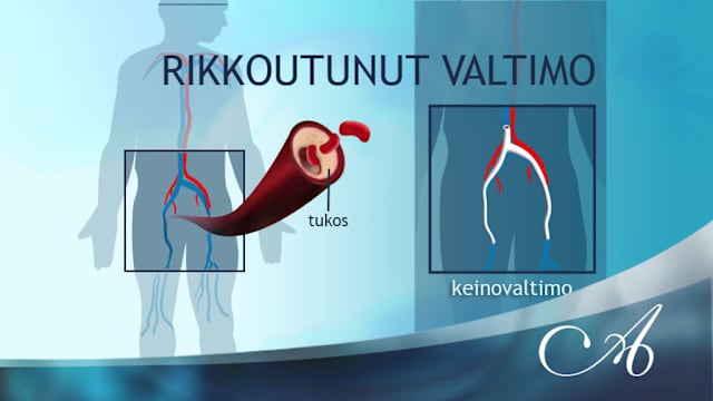 Rikkoutunut valtimo ja keinovaltimo – Omalääkäri – yle.fi