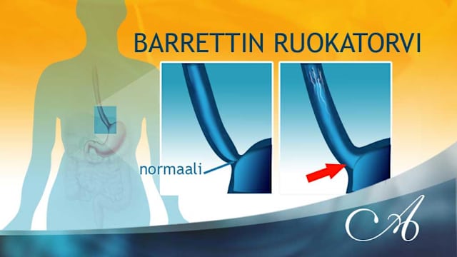 Barrettin ruokatorvi – Omalääkäri – yle.fi