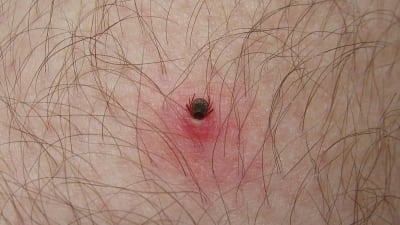 Puutiaisista on löytynyt salakavalaa borrelia-bakteeria, joka ei ...