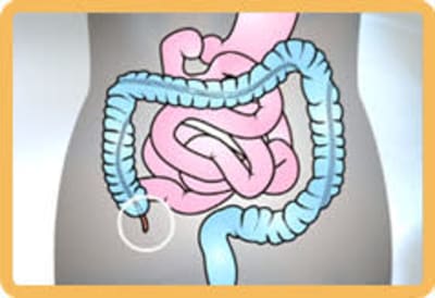 Umpilisäkkeen tulehdus hoidettava nopeasti – Akuutti – yle.fi