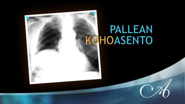 Pallean kohoasento – Omalääkäri – yle.fi
