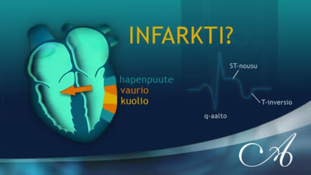 Näkyykö infarkti myöhemmin testeissä? – Omalääkäri – yle.fi