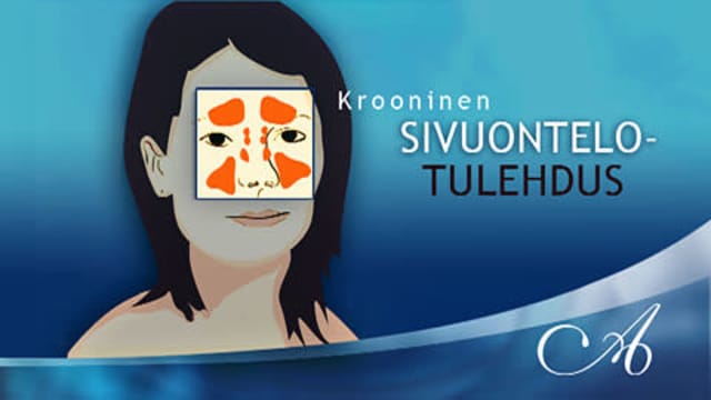 Onteloiden krooninen tulehdus – Omalääkäri – yle.fi