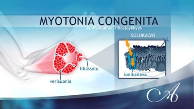 Myotonia congenita – Omalääkäri – yle.fi