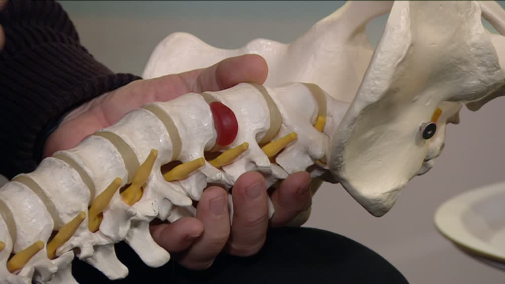 Aamutohtori: selkä- ja iskiaskipu | Aamutohtori | TV | Areena | yle.fi