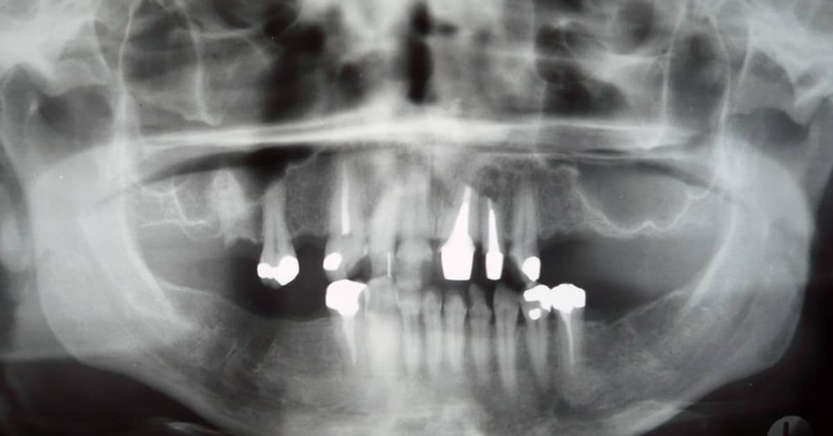 Krooninen sepelvaltimotauti voi paljastua hammaslääkärikäynnillä | Yle