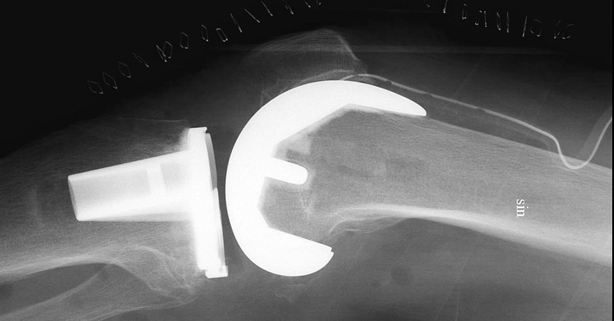 Aktivoiva tekonivelhoito puree vaivoihin | Yle