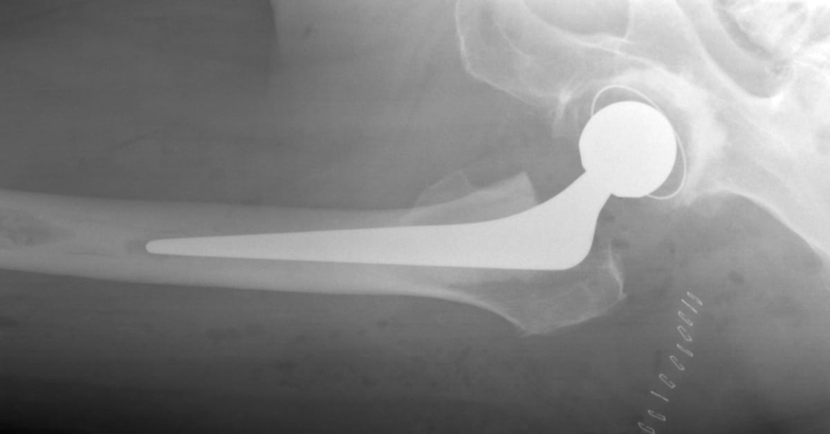 Keski-Suomessa kymmeniä riskiproteeseja | Yle