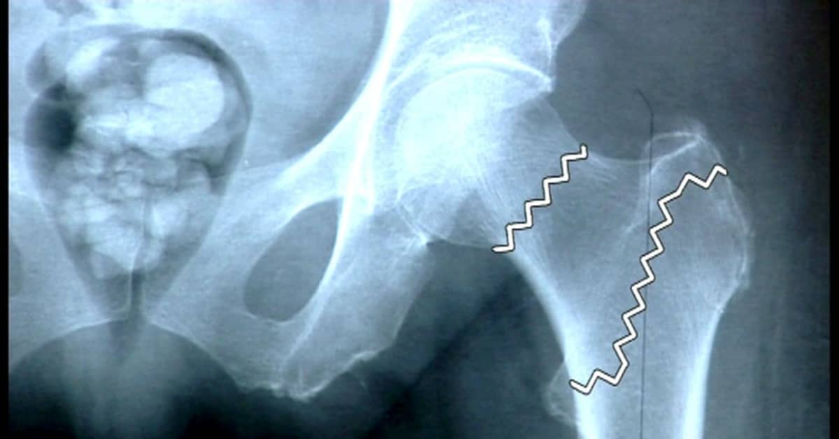 Lonkka murtuu yhä useammalta | Yle