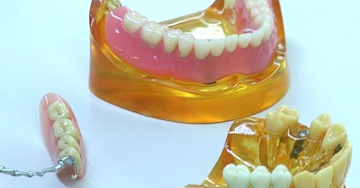 Uusi hammas maksaa maltaita – suuhun ei laiteta hyllytavaraa | Yle