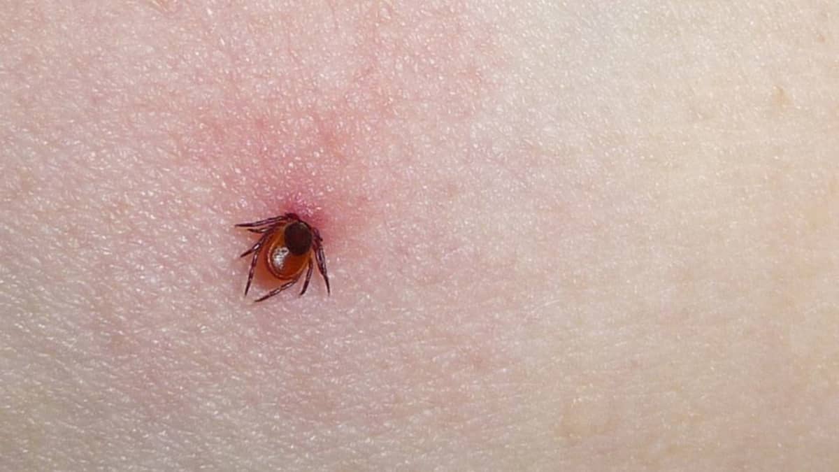 Kaameana pidetty punkkitauti onkin mainettaan kiltimpi? – "Suurin osa ...