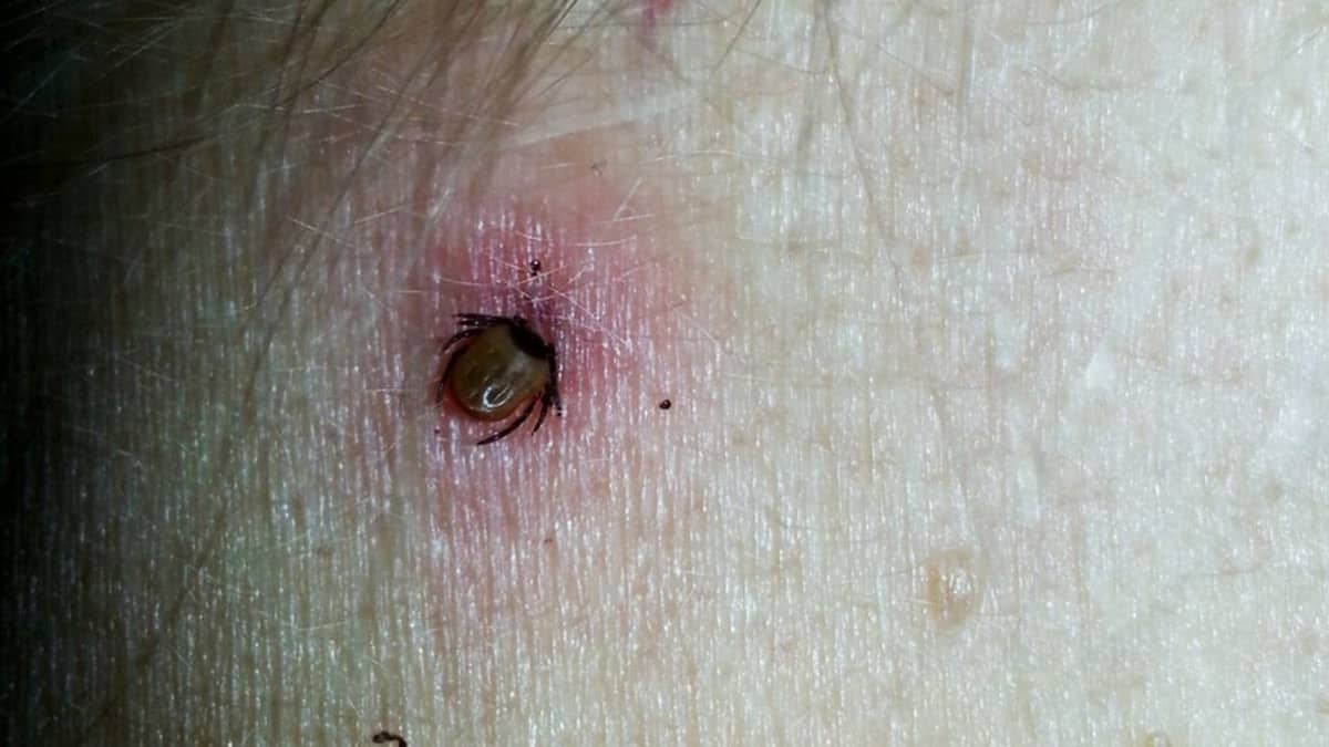 Tutkijat toivovat yleisöltä puutiaisnäytteitä | Yle Uutiset